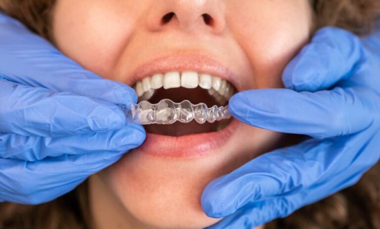 Air Gap Invisalign Tracking Explained: Causes, Signs, and Solutions ...